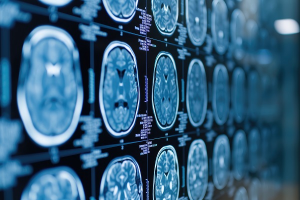 What Are Common Brain Injuries From Car Accidents? | Law Offices of ...